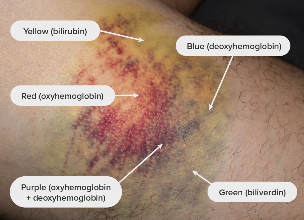 Red Blood Cells and Hemoglobin Tutorial | Sophia Learning